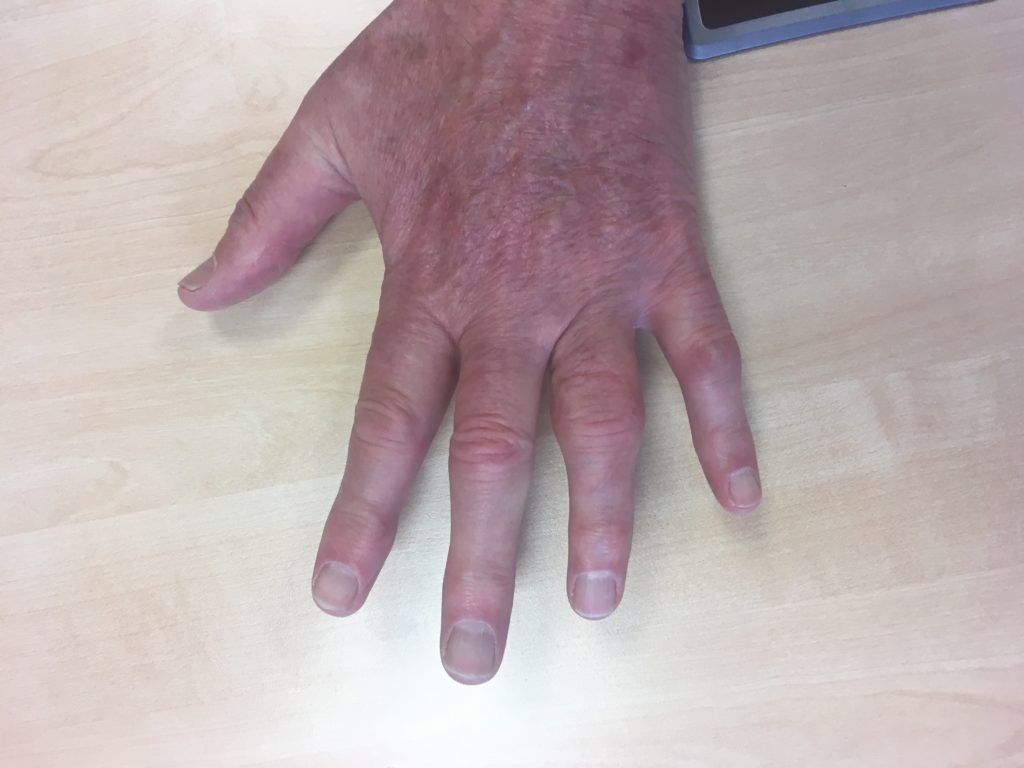 Finger joint replacement: A patients journey - Harrogate Hand Clinic ...