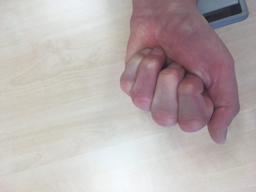 Finger joint replacement: A patients journey - Harrogate Hand Clinic ...